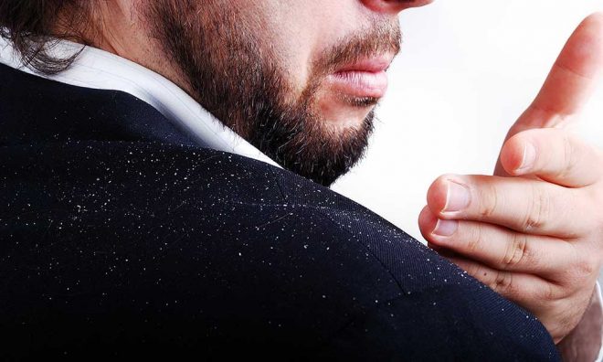 Anti Dandruff Shampoos - You Won't Believe Shocking Facts About Them
