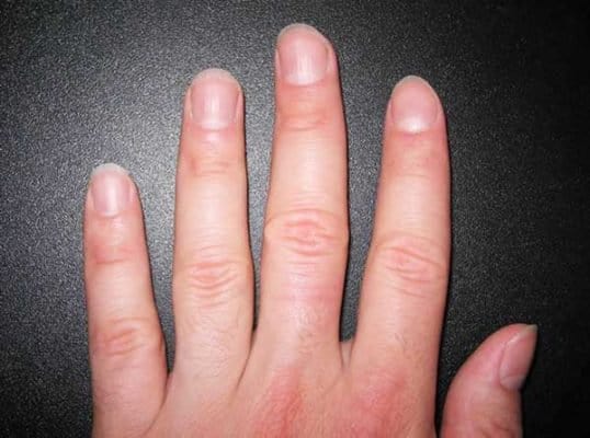 Nails That Tell Health Condition - Nails Indicate diseases