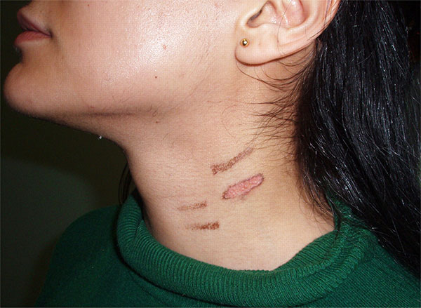 View Laser Hair Removal Side Effects Pics - onurcanaydogmus View Laser Hair Removal Side Effects Pics - onurcanaydogmus